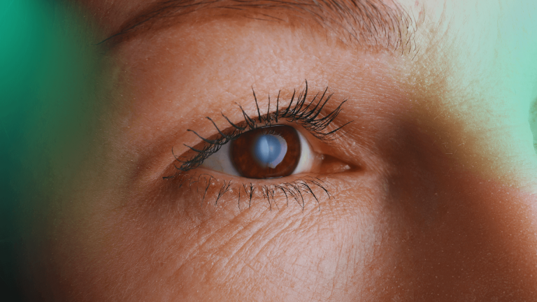 Cataracts: All You Need to Know